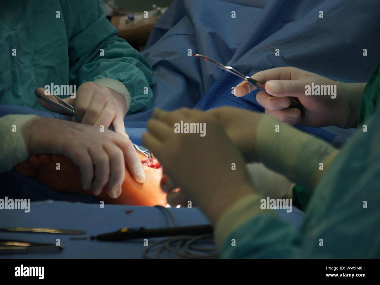 Multiple fracture hi-res stock photography and images - Alamy