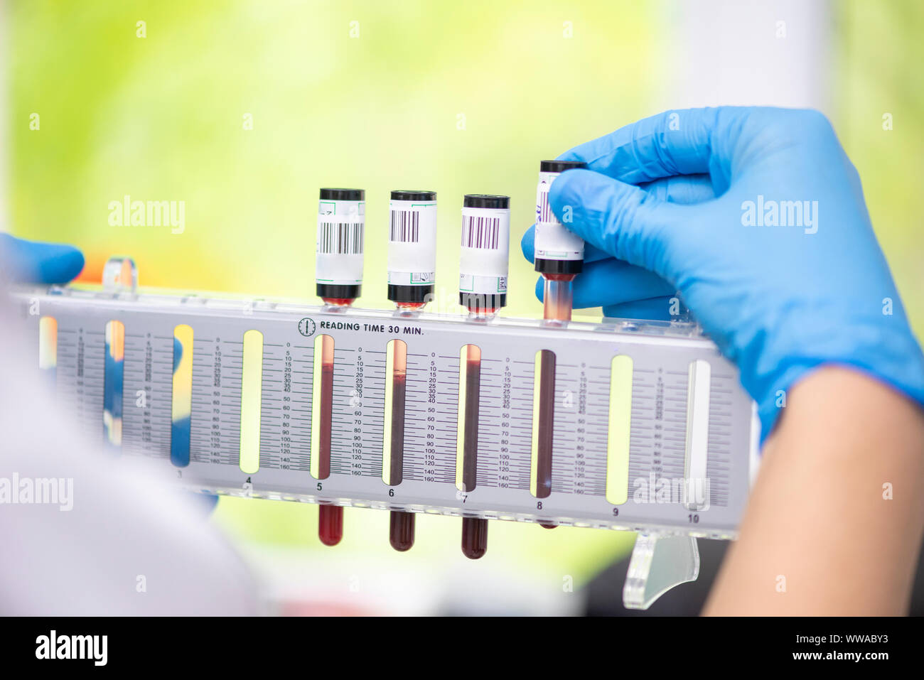 Erythrocyte sedimentation rate test in laboratory Stock Photo - Alamy