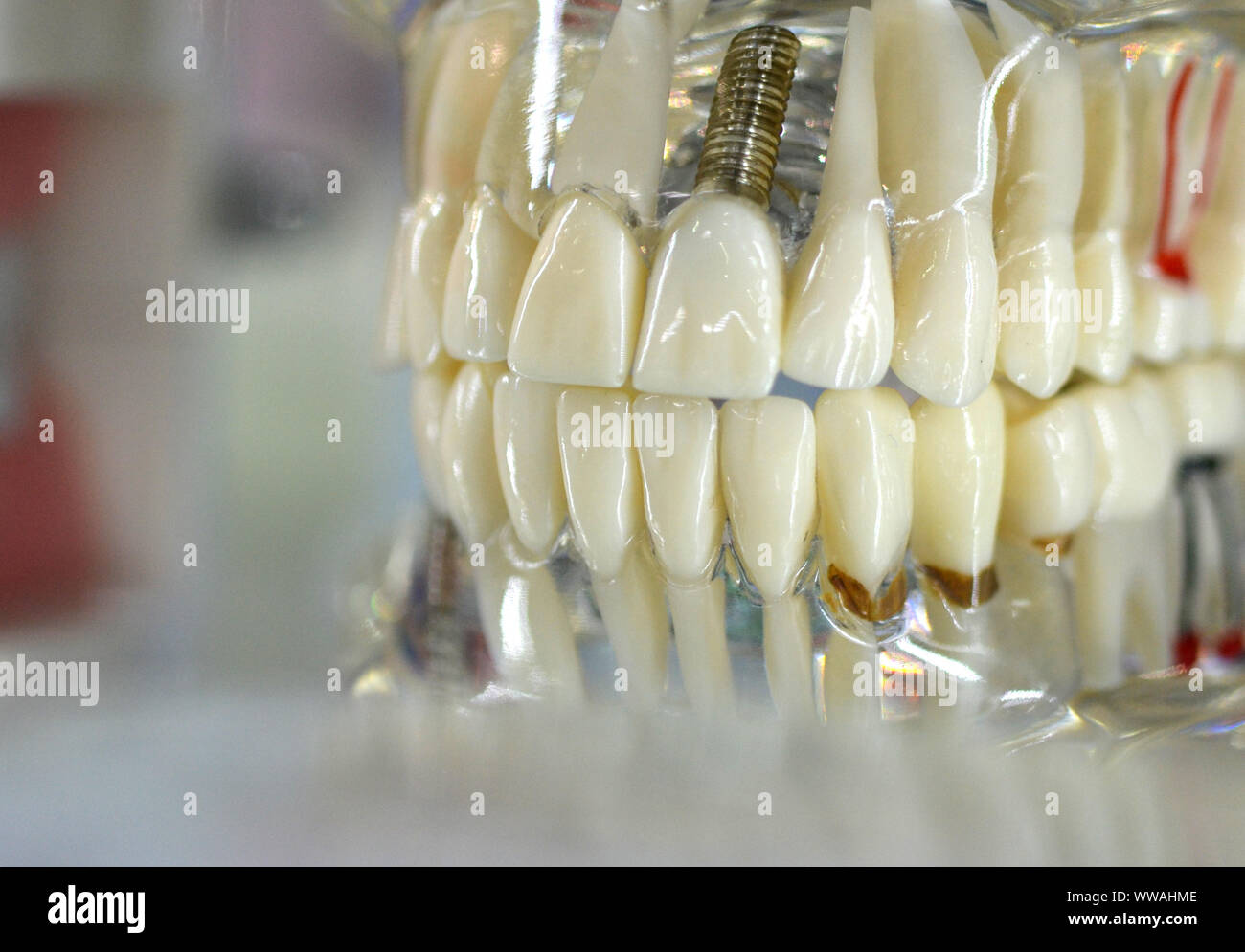 Transparent Model of Human Teeth with implants close-up Stock Photo - Alamy