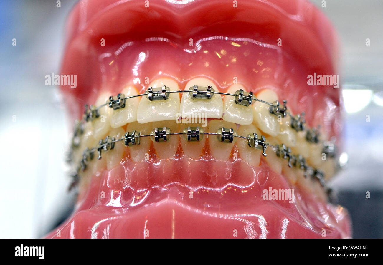 braces on a model of human teeth, dental tooth dentistry close-up Stock ...