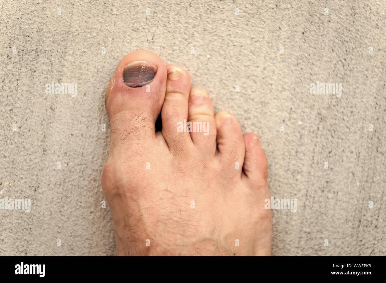 Nail Disease High Resolution Stock Photography and Images - Alamy