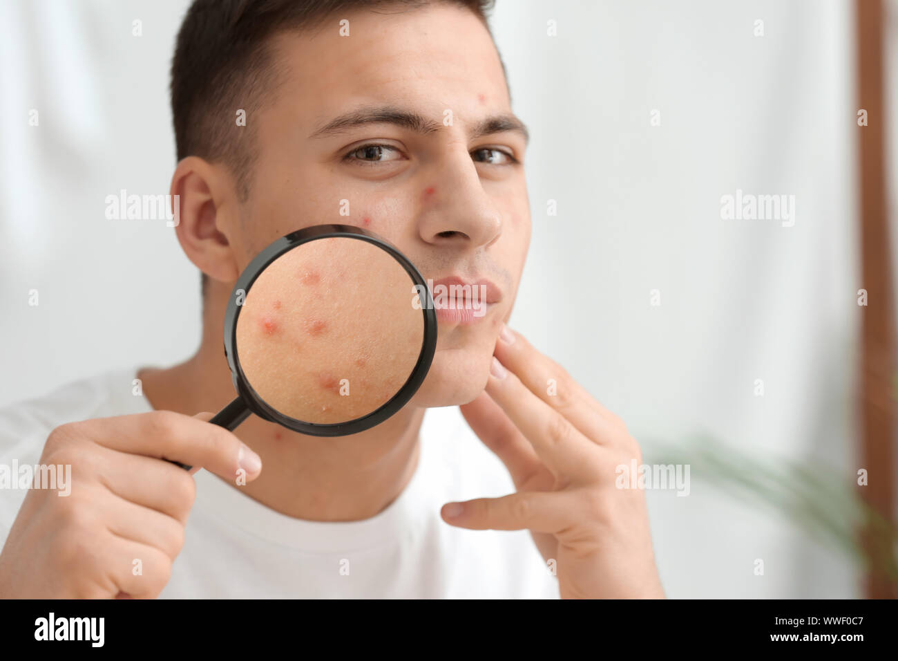 Man with acne hi-res stock photography and images - Alamy