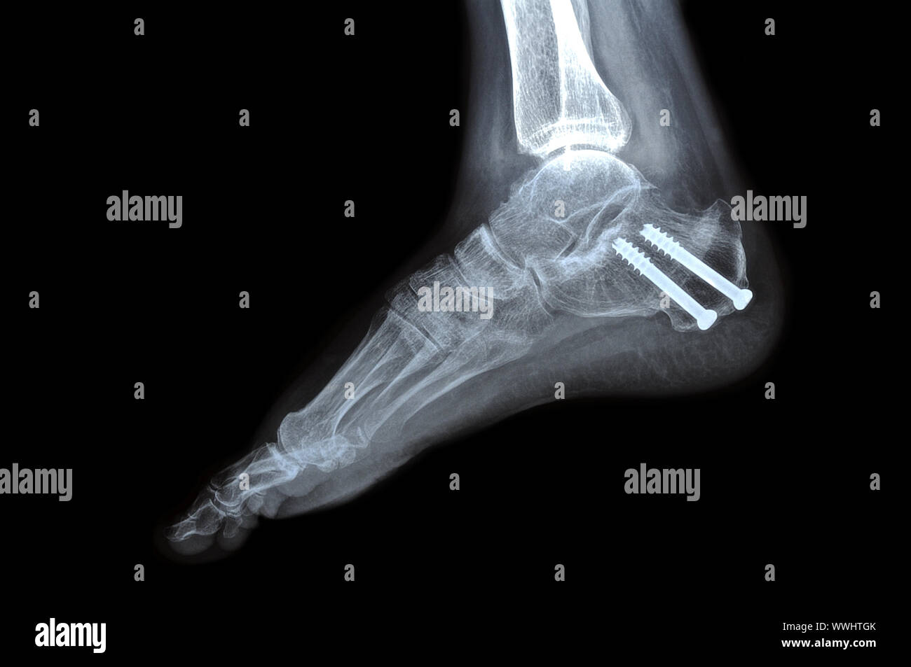 Ankle osteosynthesis hi-res stock photography and images - Alamy