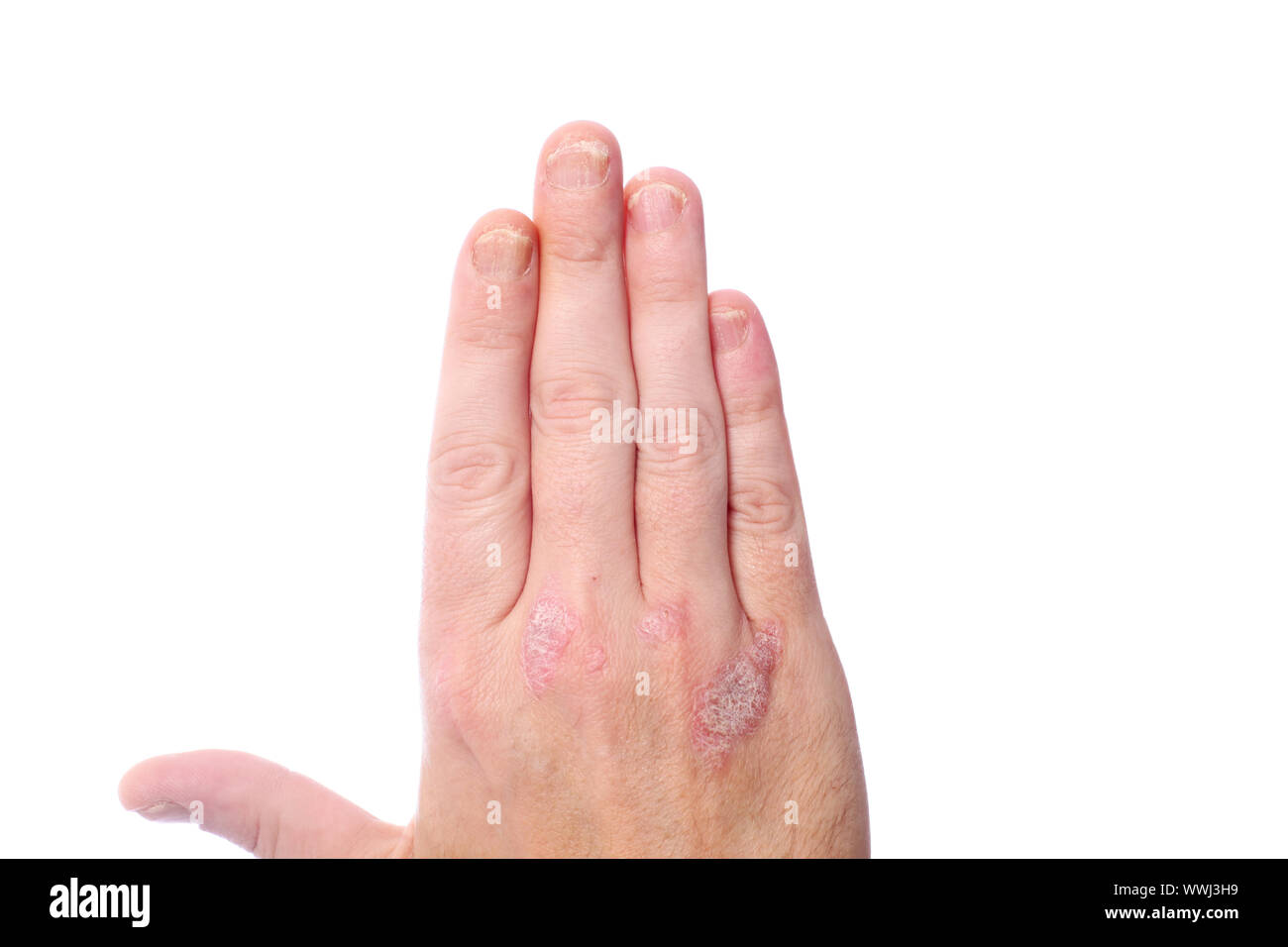 Psoriasis on hands hi-res stock photography and images - Alamy