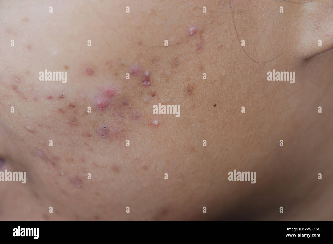 problem of facial skin is that the hormones cause acne on a woman face ...