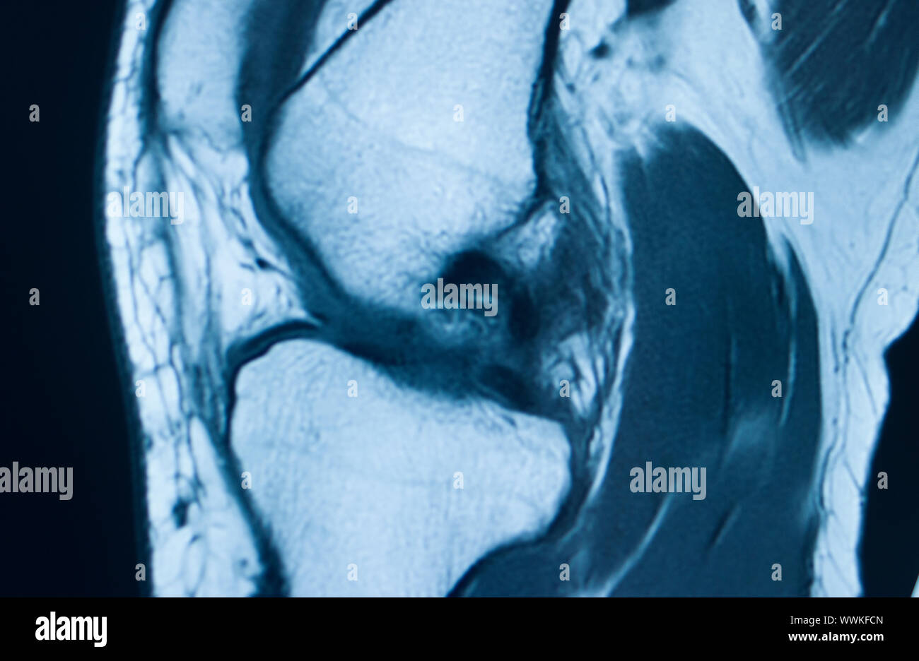 Knee sports injury mri mcl grade 2 tear magnetic resonance imaging ...