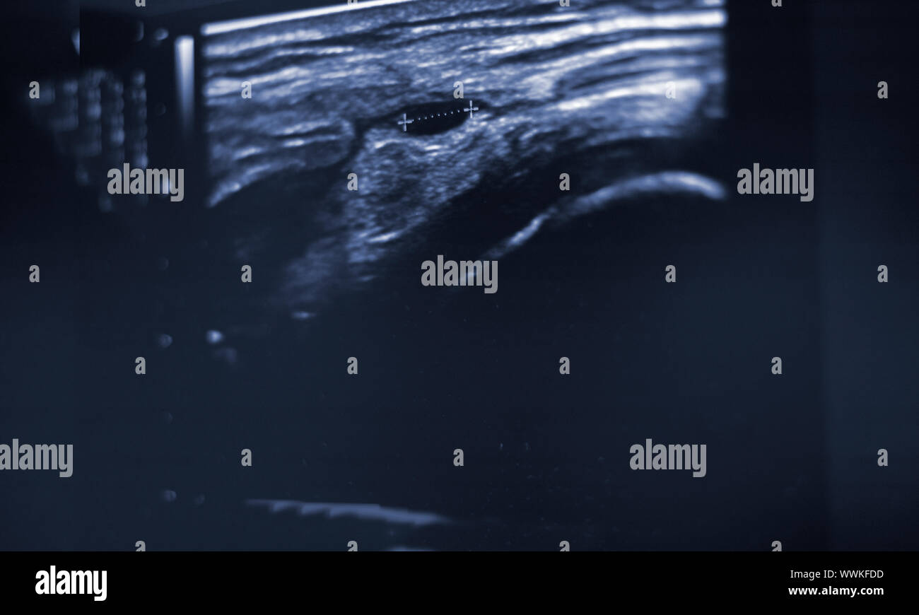 EPI Intratissue Percutaneous Electrolysis dry needling ultrasound ...