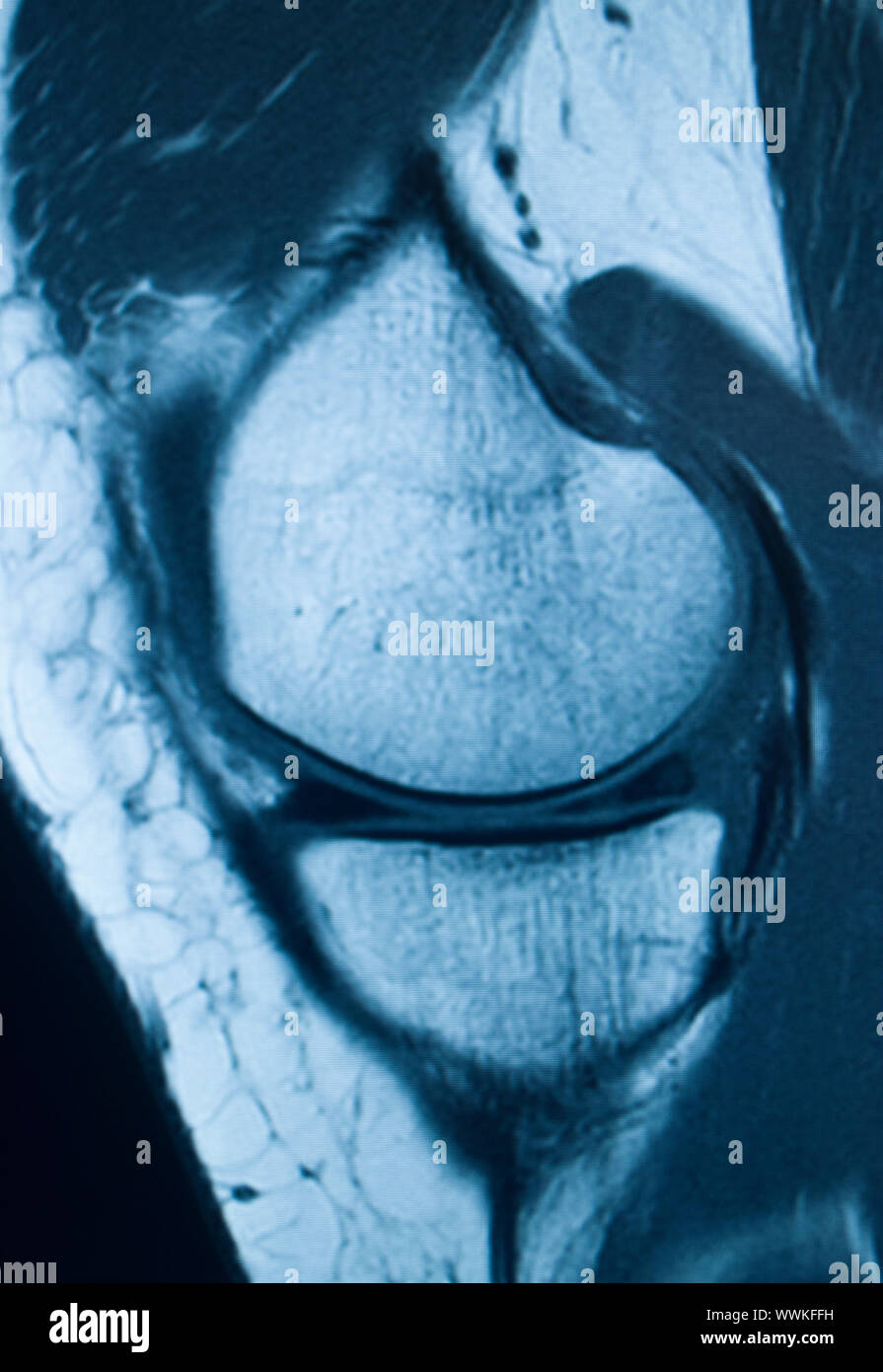 Knee sports injury mri mcl grade 2 tear magnetic resonance imaging ...