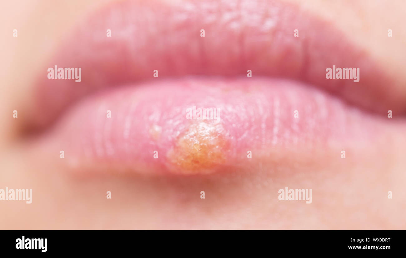 Cold Sore On Lip Swollen