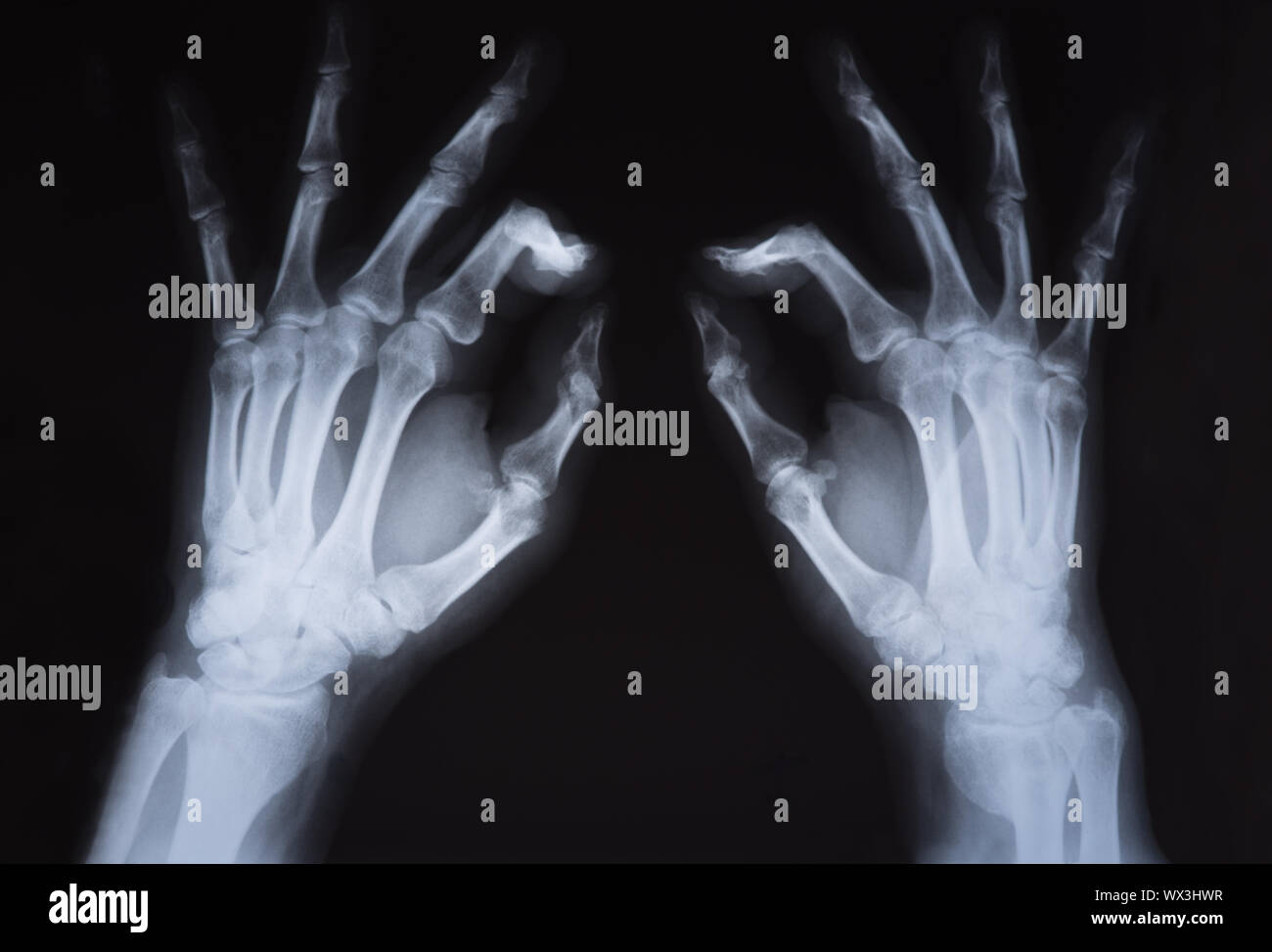 X Ray Of Palm High Resolution Stock Photography and Images - Alamy