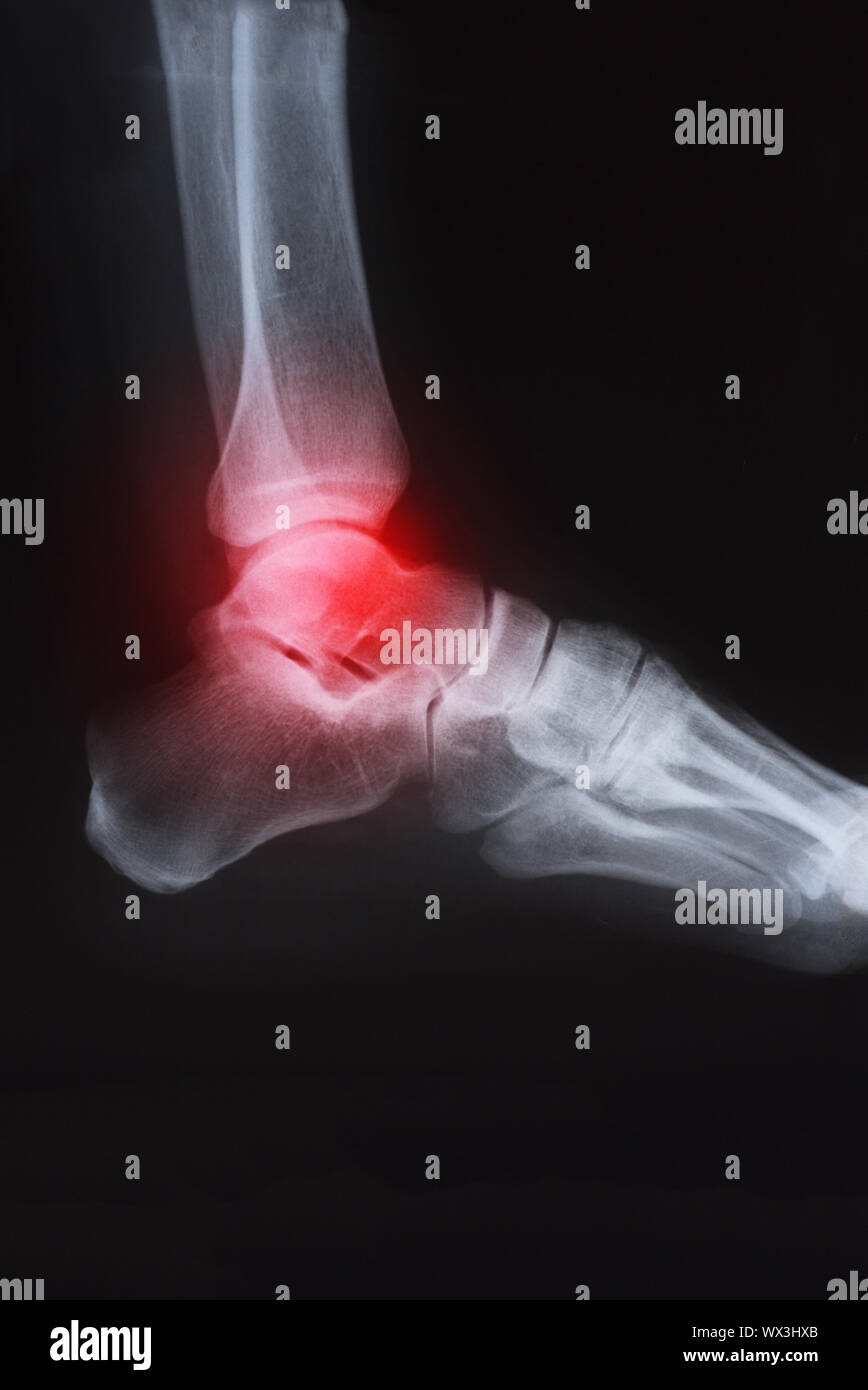 X ray image of ankle with arthritis Stock Photo - Alamy