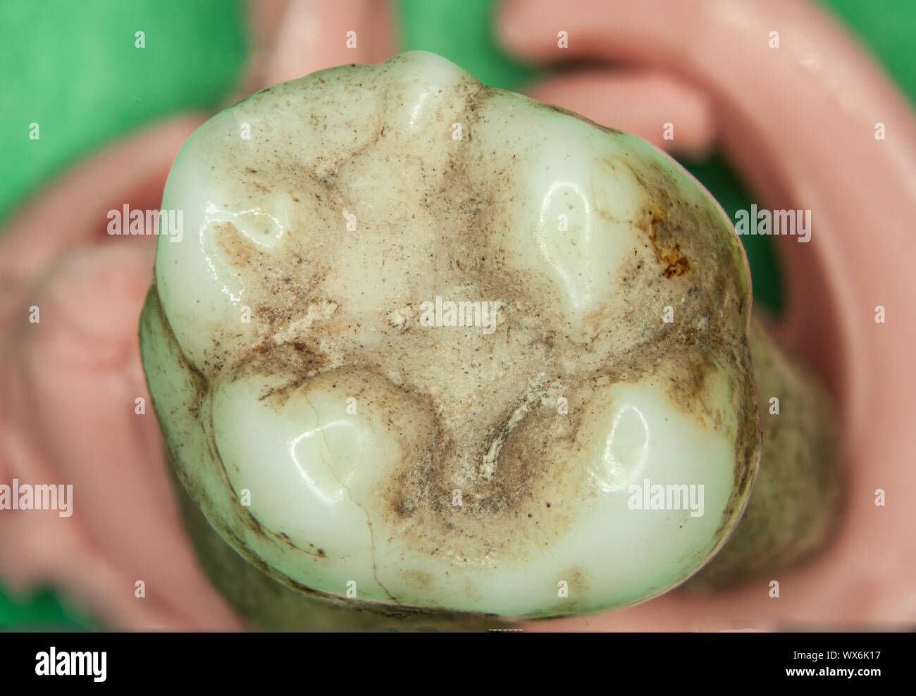 Molar tooth with tooth decay Stock Photo - Alamy