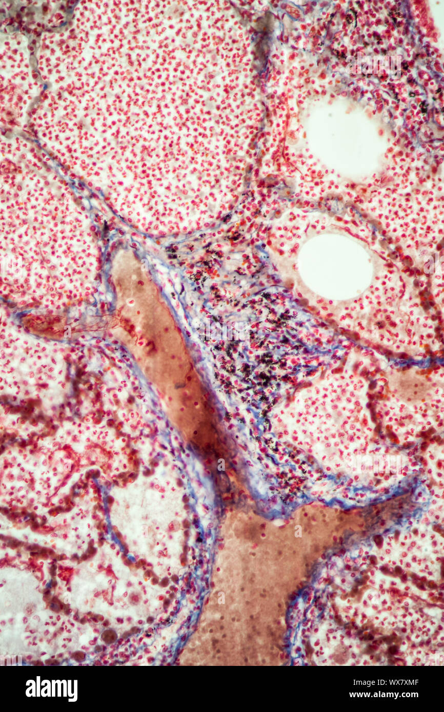 Pulmonary tuberculosis hi-res stock photography and images - Alamy