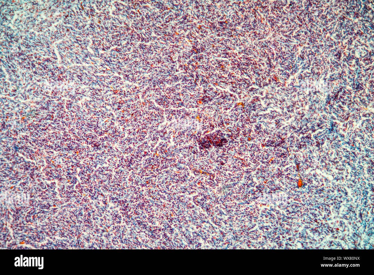 Gallbladder tumor tissue under the microscope 100x Stock Photo - Alamy