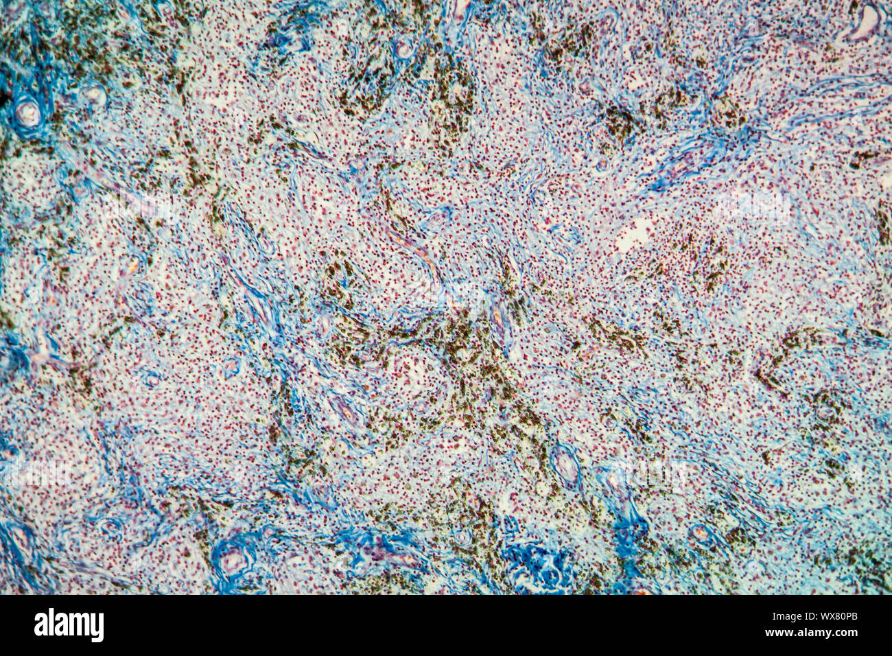 Foreign body granuloma tissue under the microscope 100x Stock Photo - Alamy