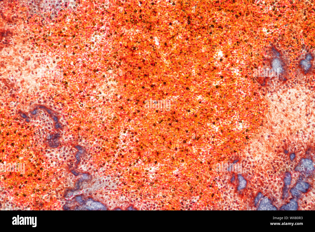 Fatty heart hi-res stock photography and images - Alamy