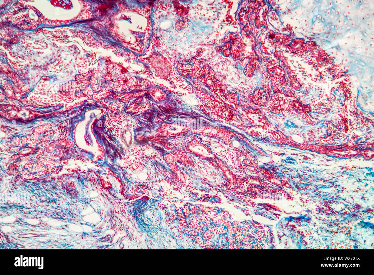 Mixed tumor of the parotid gland Diseased tissue 100x Stock Photo - Alamy