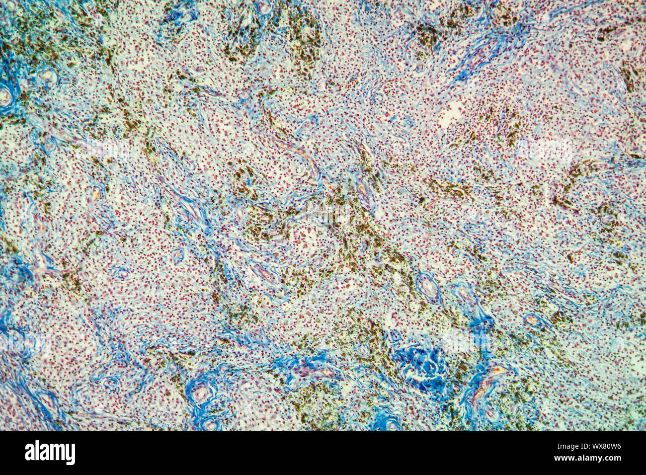 Foreign body granuloma tissue under the microscope 100x Stock Photo - Alamy