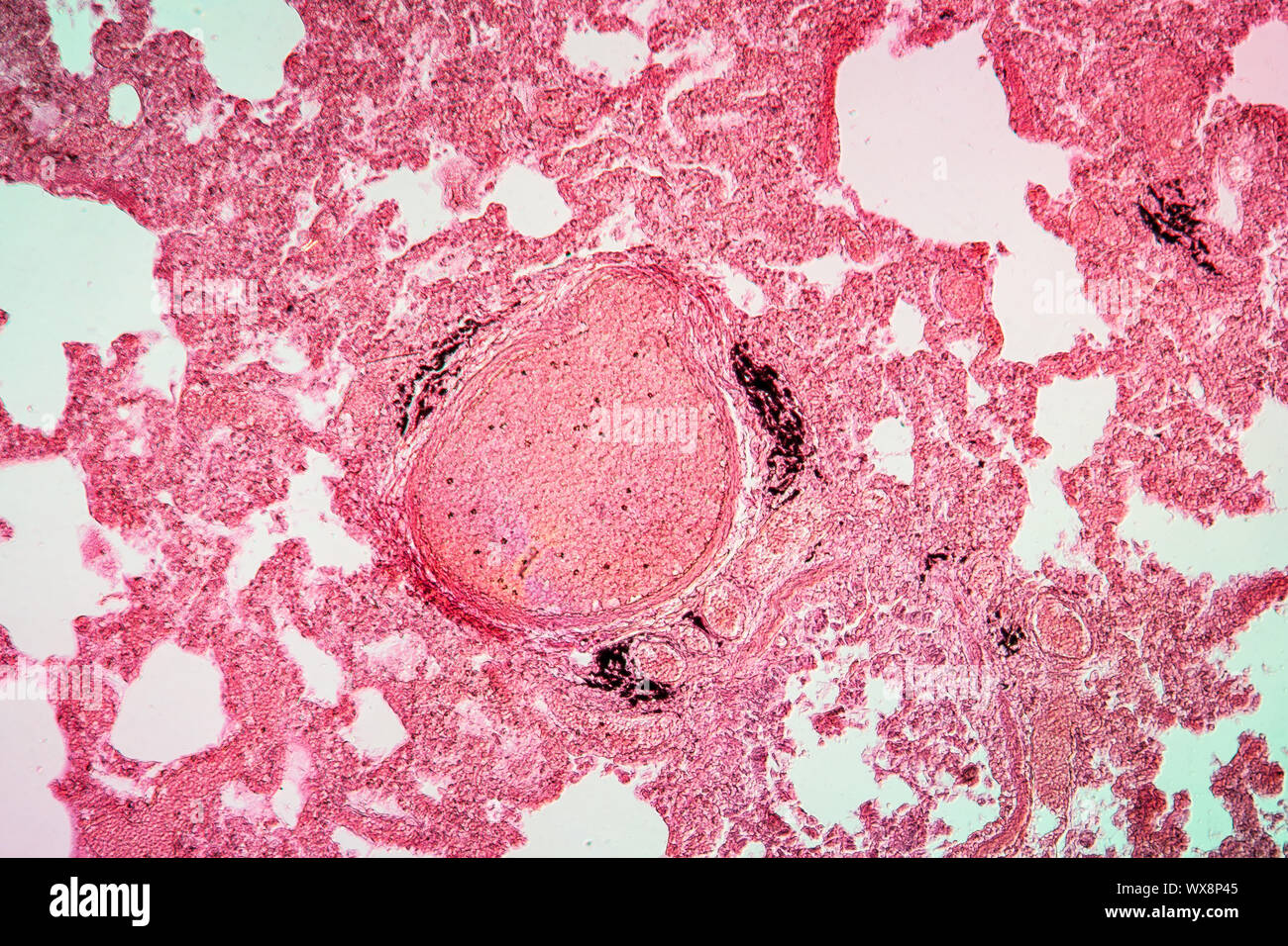 Embolism after bone fracture 100x Stock Photo - Alamy