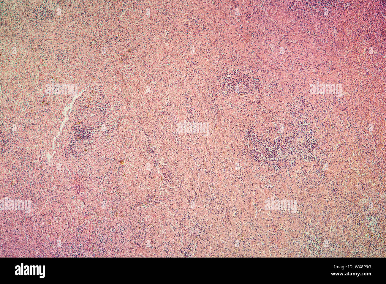 Heart calluses scars in the heart muscle 100x Stock Photo - Alamy