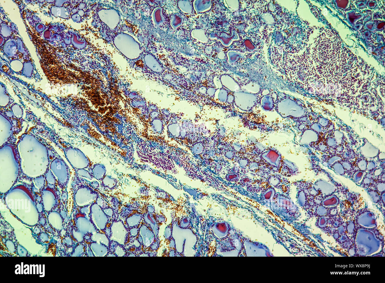 Thyroid goiter hi-res stock photography and images - Alamy