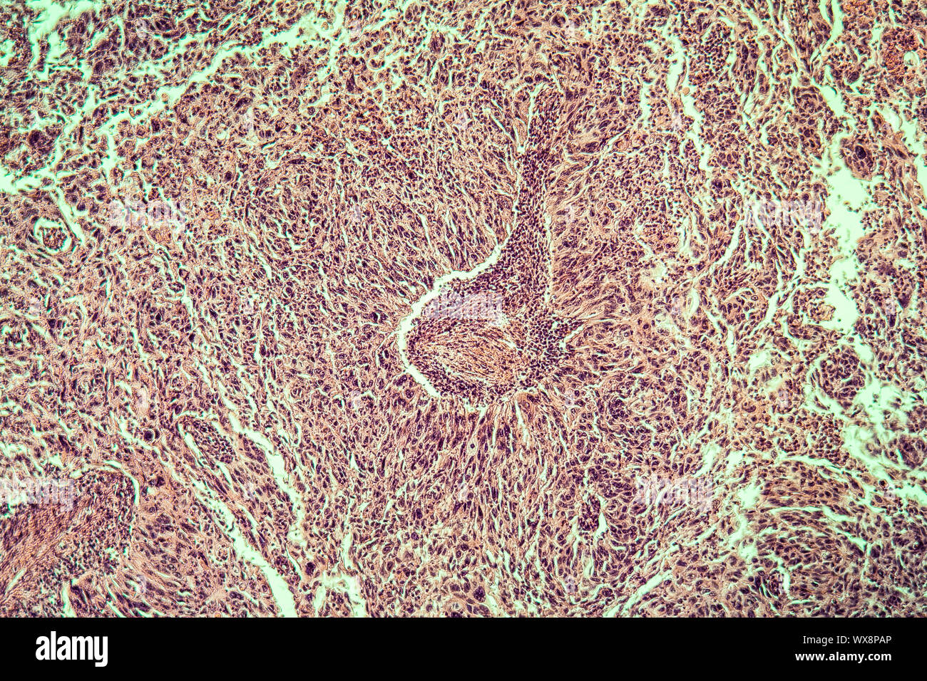 Cervical carcinoma diseased tissue 100x Stock Photo - Alamy