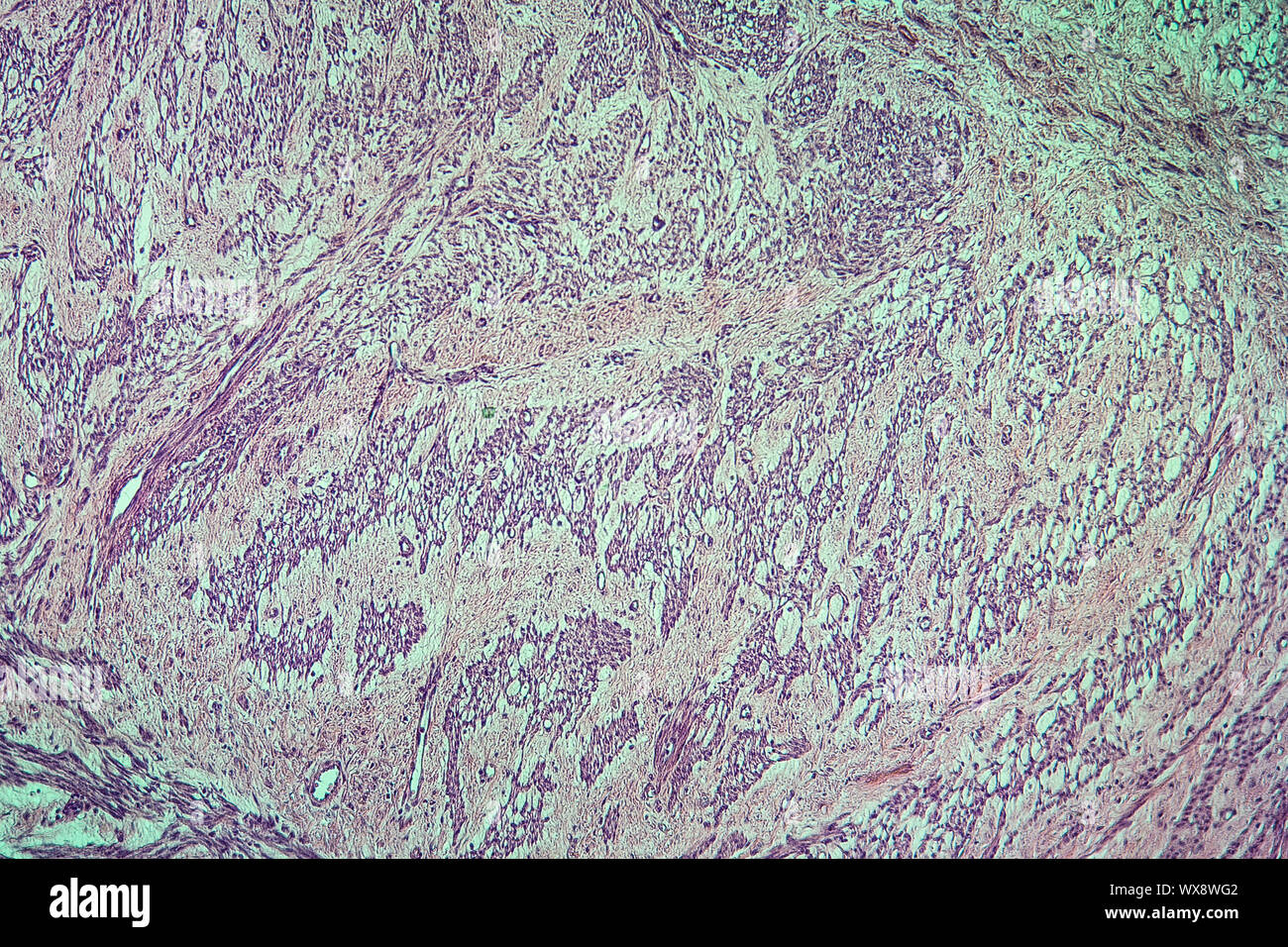 Fibromyoma, good tumor of the uterus diseased tissue 100x Stock Photo ...