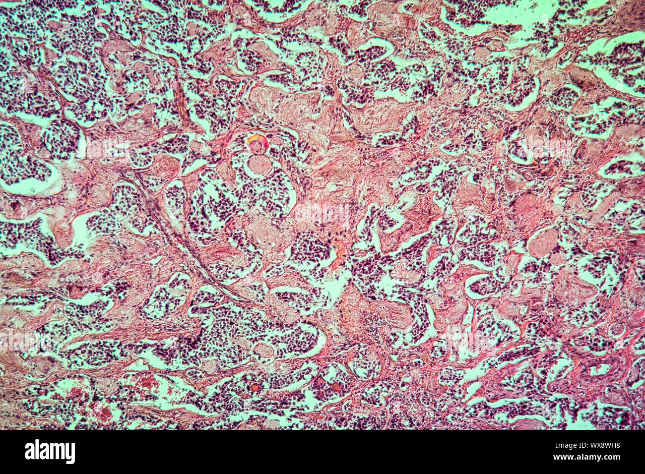 Thyroid scirrhous carcinoma diseased tissue 100x Stock Photo - Alamy