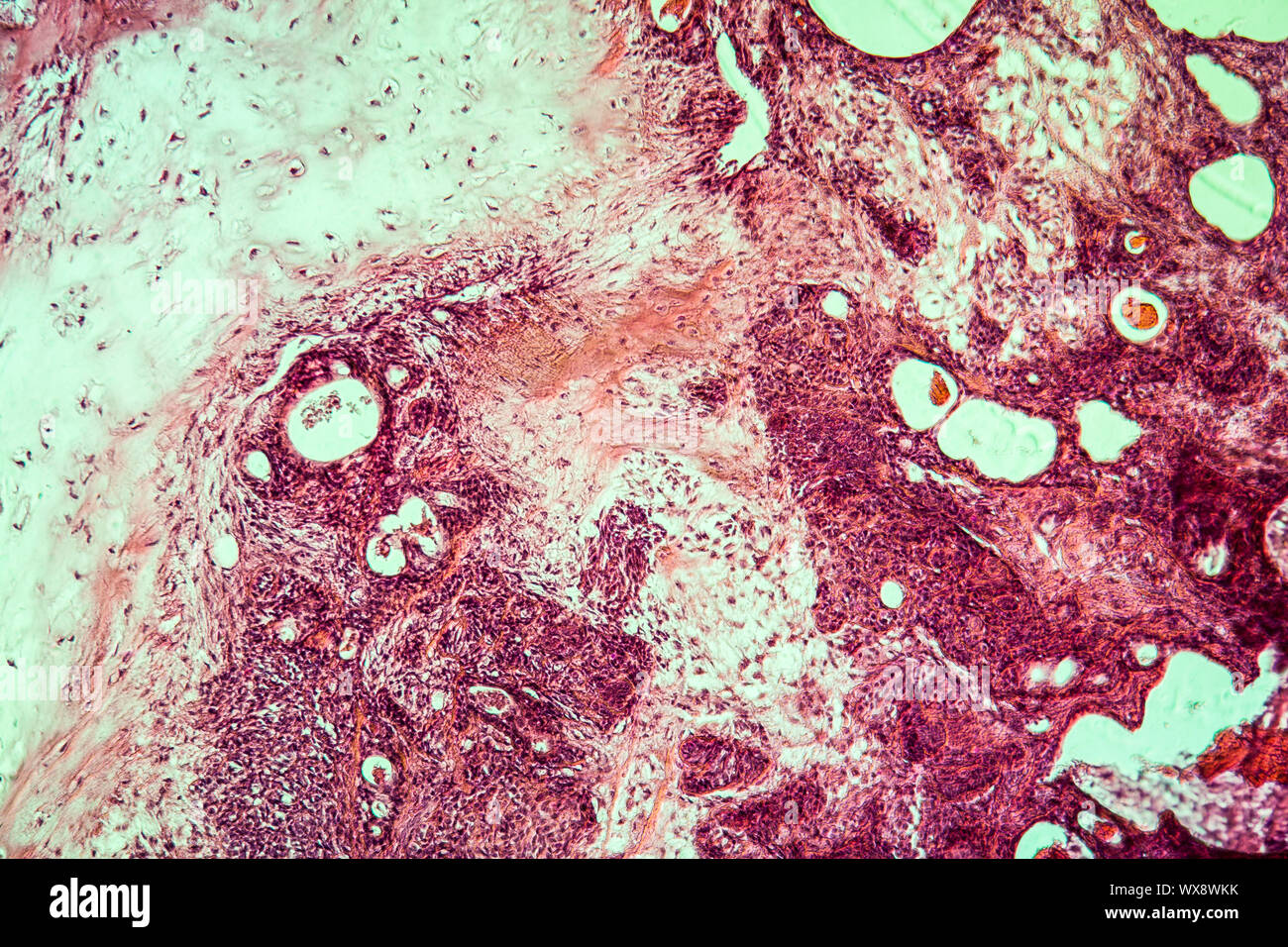 Mixed tumor of parotid diseased tissue 100x Stock Photo - Alamy