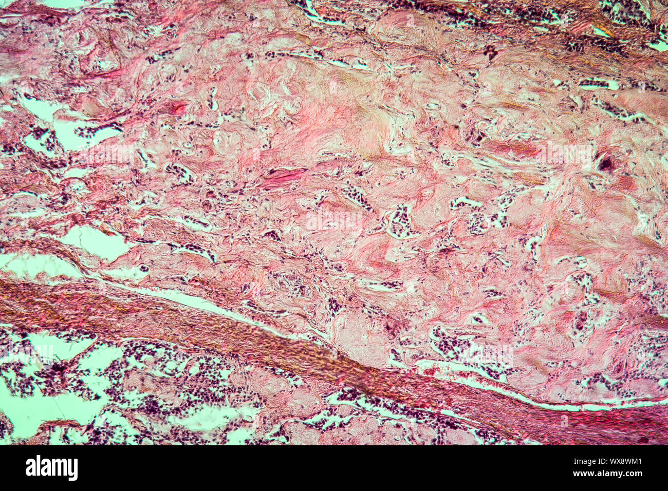 Thyroid scirrhous carcinoma diseased tissue 100x Stock Photo - Alamy