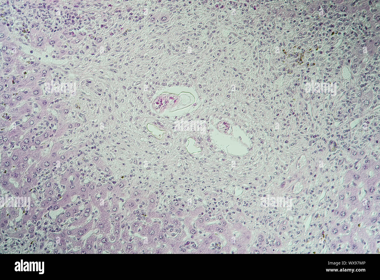 Liver mouse, schistosomiasis diseased tissue 100x Stock Photo - Alamy