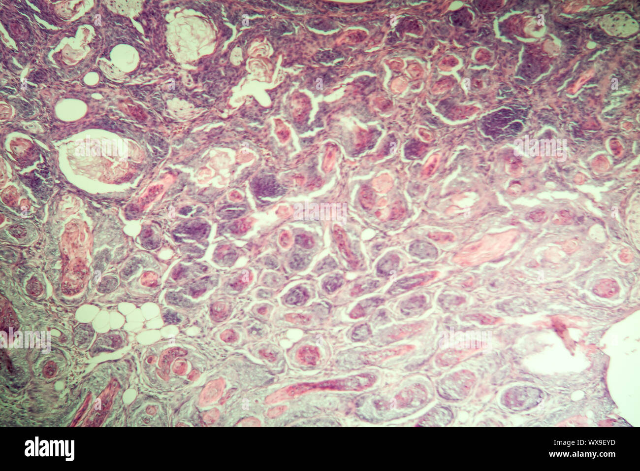 Spinaliom carcinoma in guinea pig, tissue 200x Stock Photo - Alamy