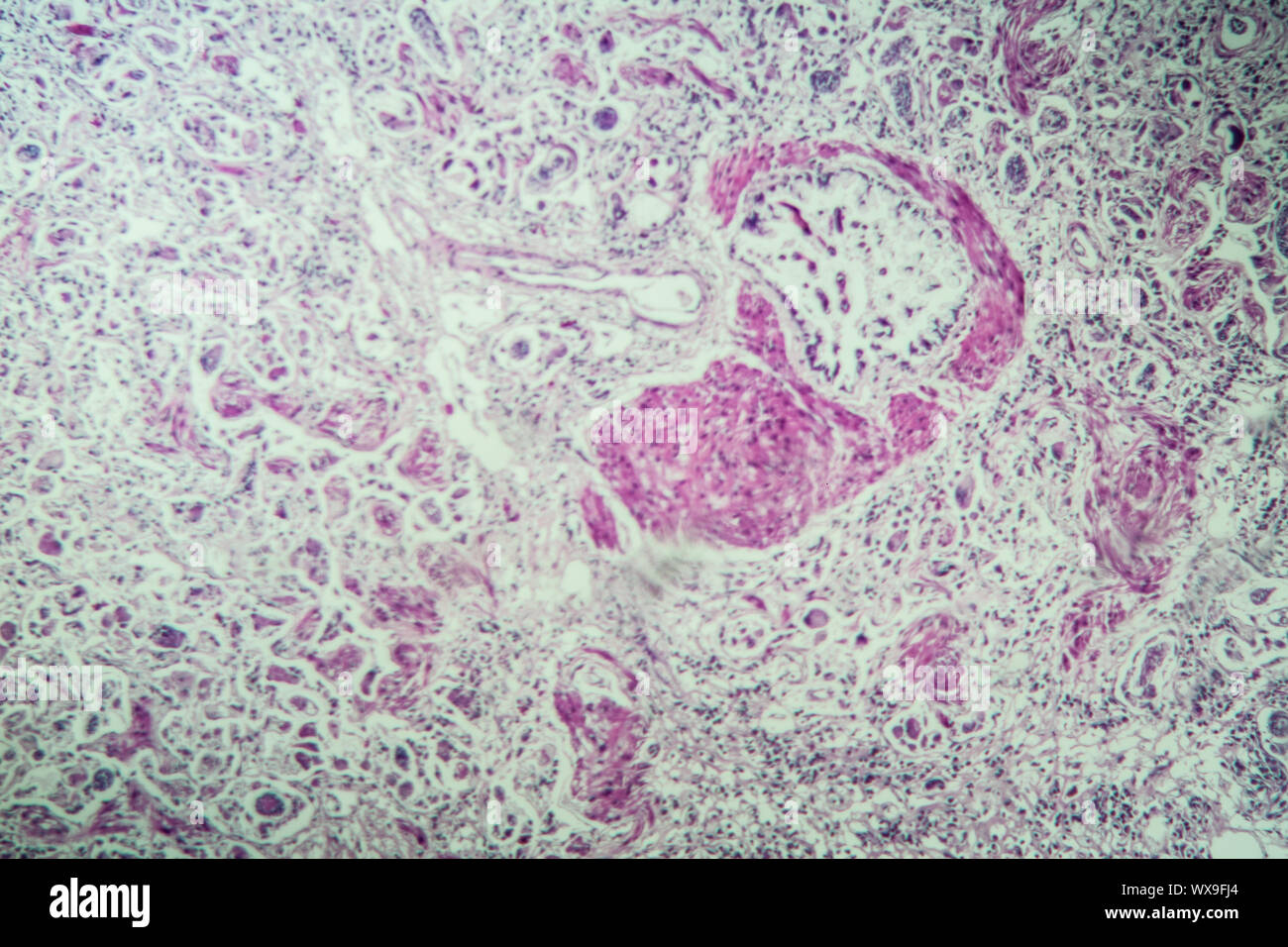 Lungworm hi-res stock photography and images - Alamy