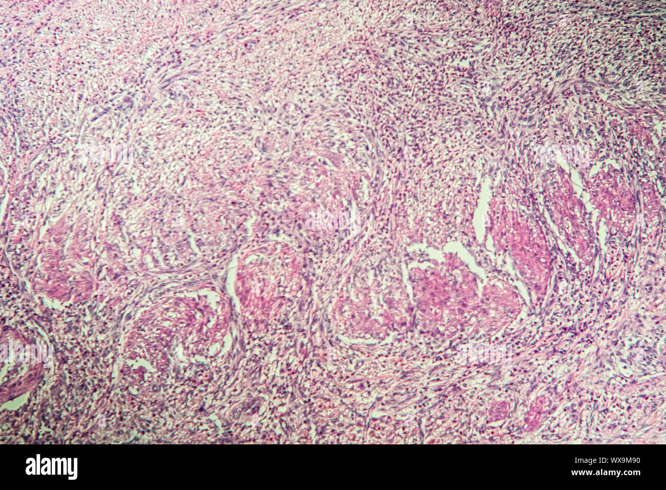 Gallbladder necrosis tissue under the microscope 100x Stock Photo - Alamy