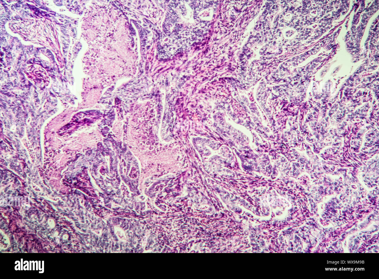 Cancer of the stomach histology hi-res stock photography and images - Alamy