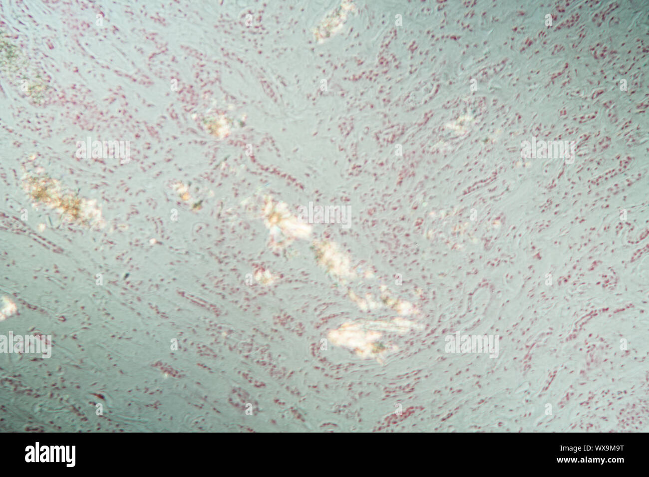 Kidney tissue with gout tissue under microscope 200x Stock Photo - Alamy