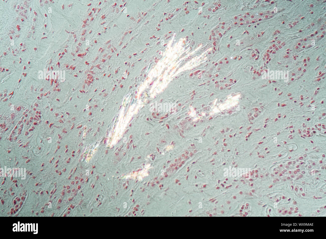 Kidney tissue with gout tissue under microscope 200x Stock Photo - Alamy