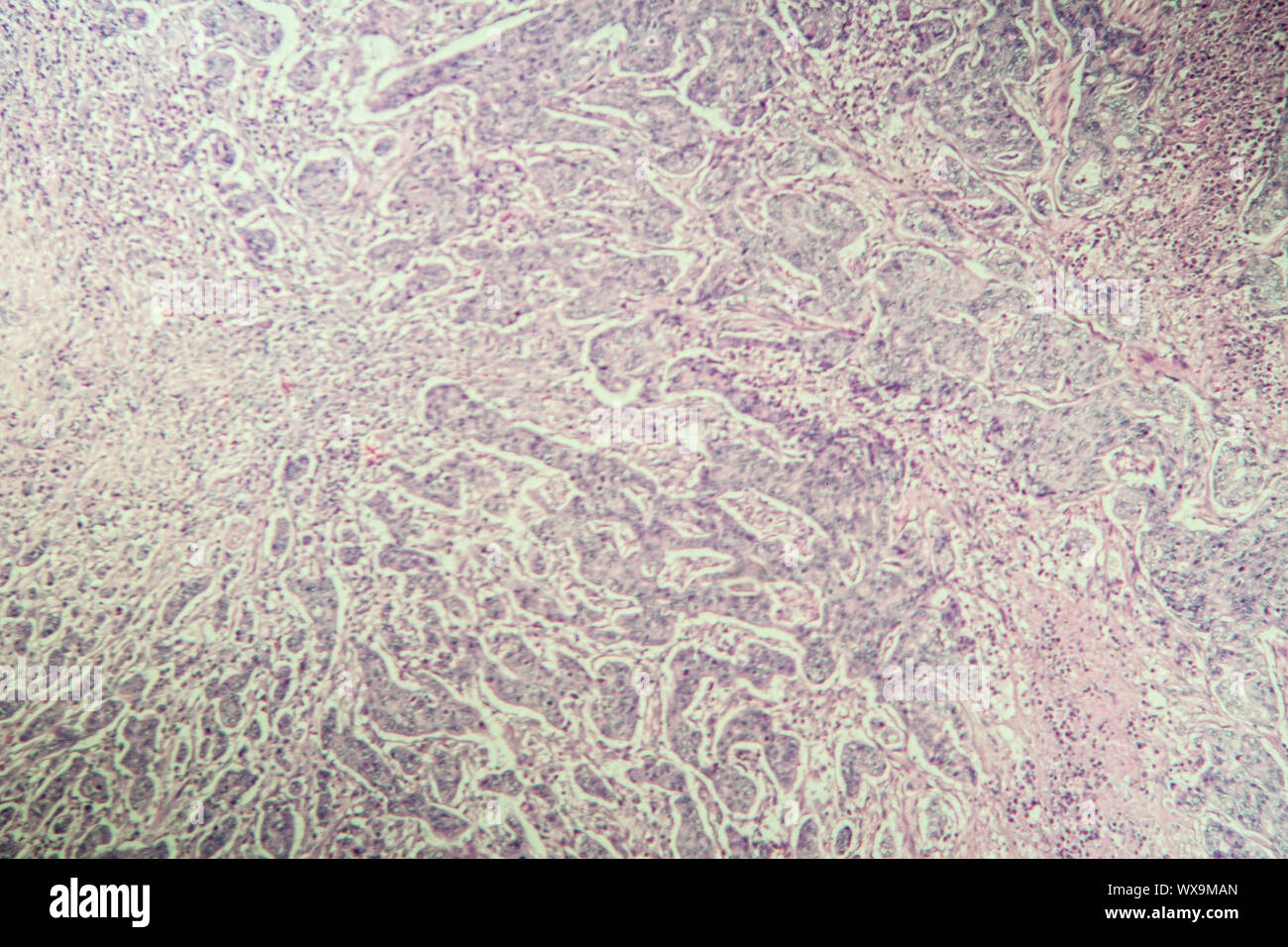 Intestinal stomach carcinoma cancer tissue 100x Stock Photo - Alamy