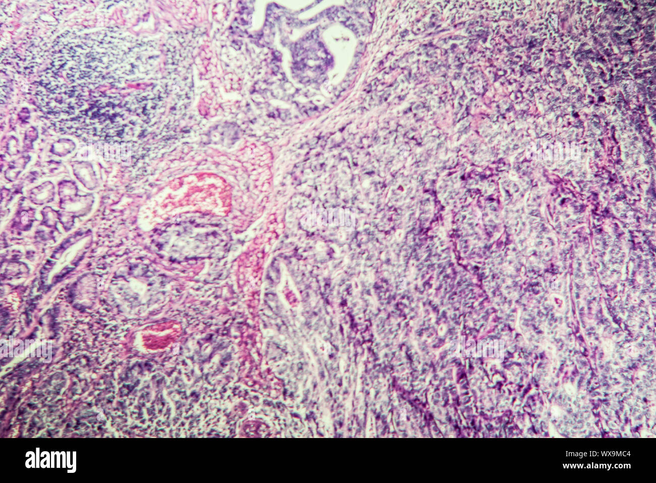 Stomach carcinoma tissue section 100x Stock Photo - Alamy