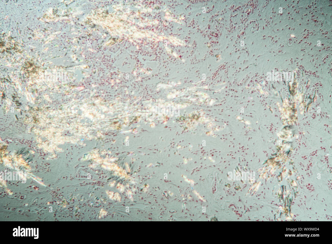 Kidney tissue with gout tissue under microscope 200x Stock Photo - Alamy