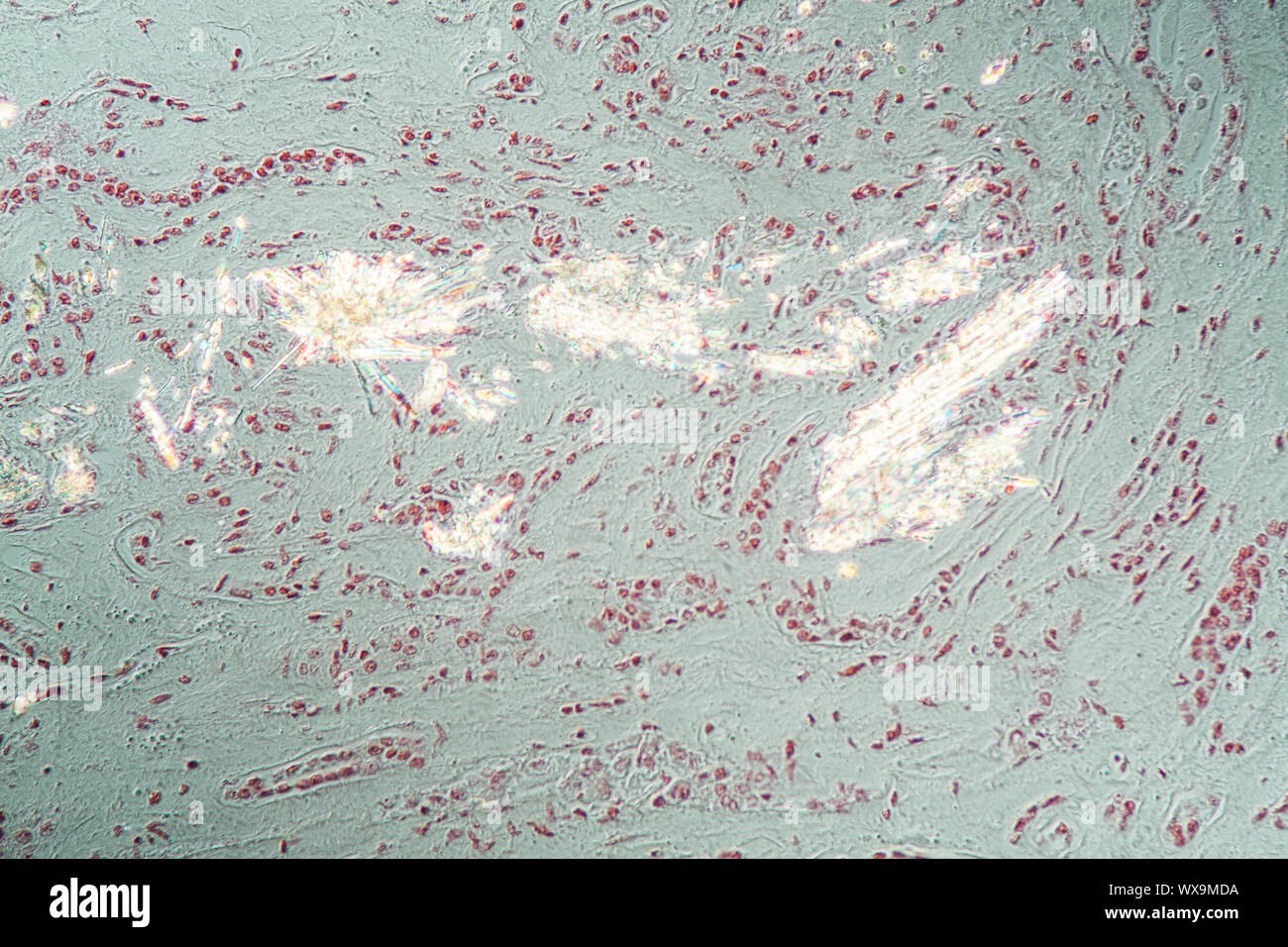 Kidney tissue with gout tissue under microscope 200x Stock Photo - Alamy