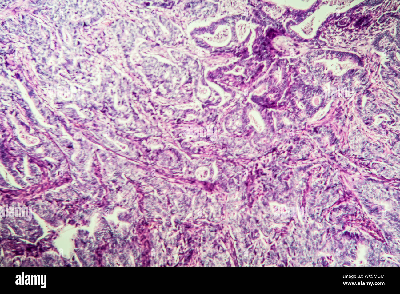 Cancer of the stomach histology hi-res stock photography and images - Alamy
