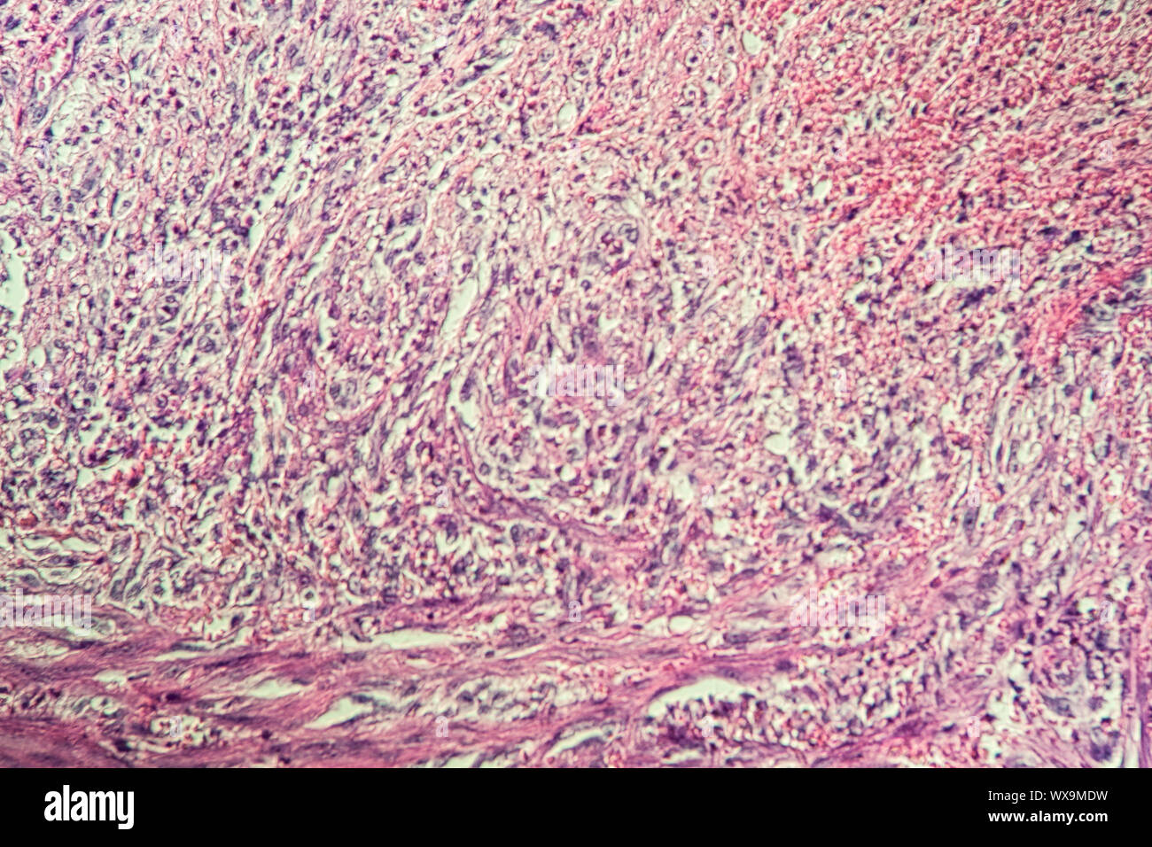 Gallbladder necrosis tissue under the microscope 100x Stock Photo - Alamy