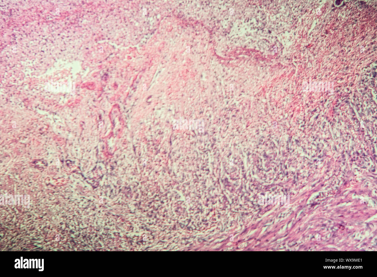 Nekrose hi-res stock photography and images - Alamy