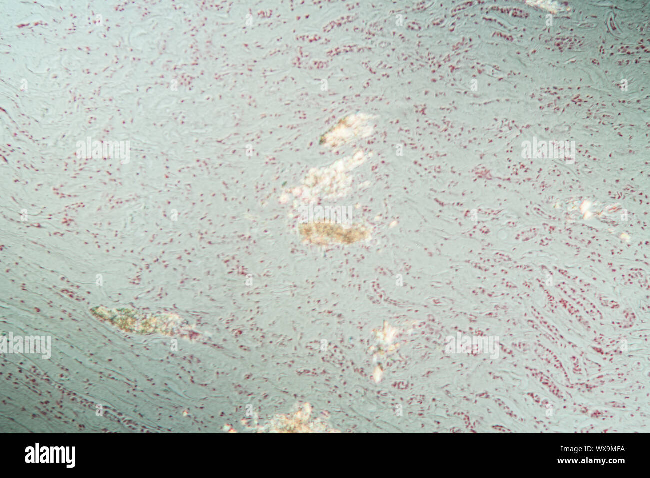 Kidney tissue with gout tissue under microscope 100x Stock Photo - Alamy