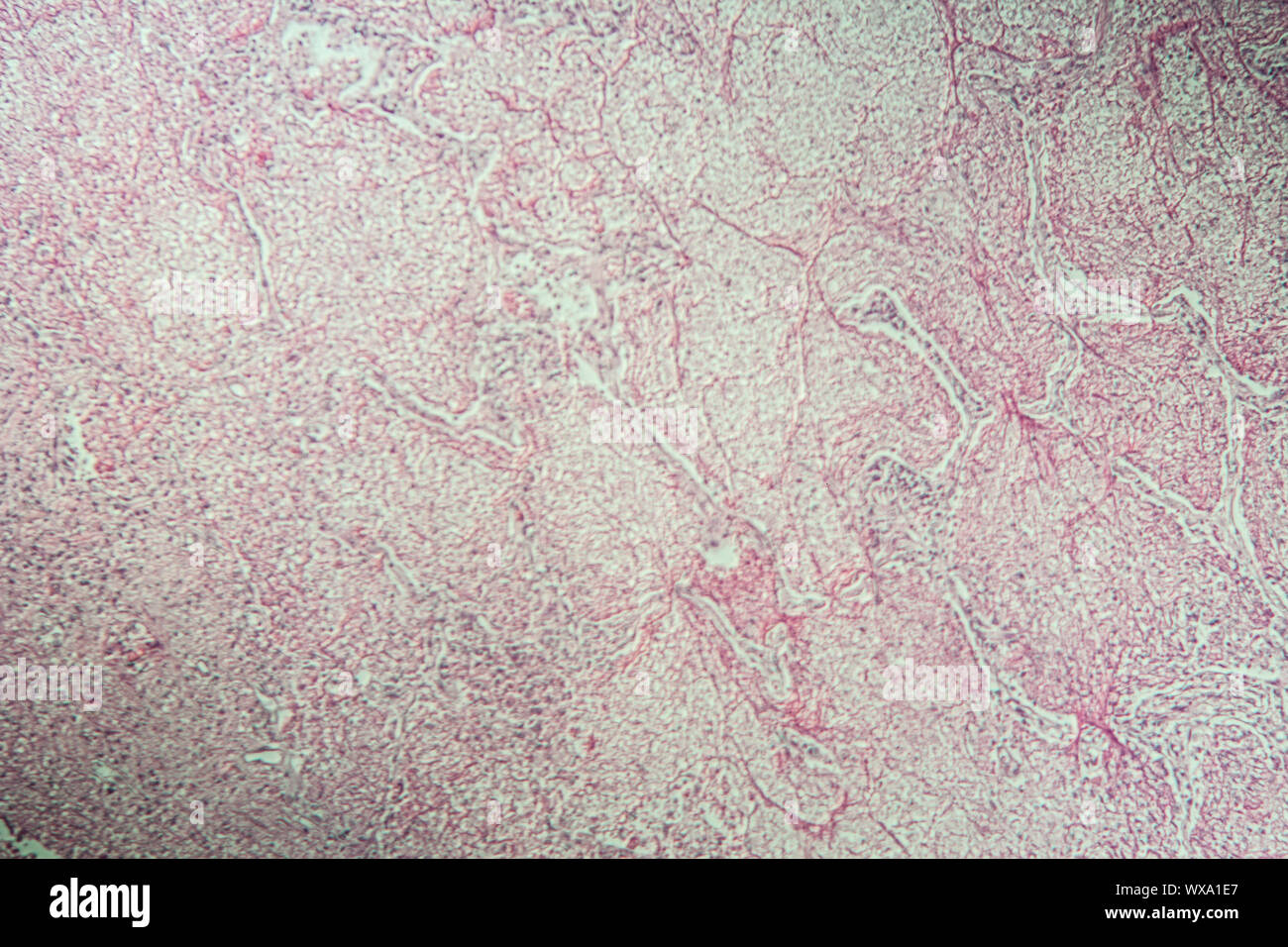 Pneumonia inflamed tissue under the microscope 100x Stock Photo - Alamy