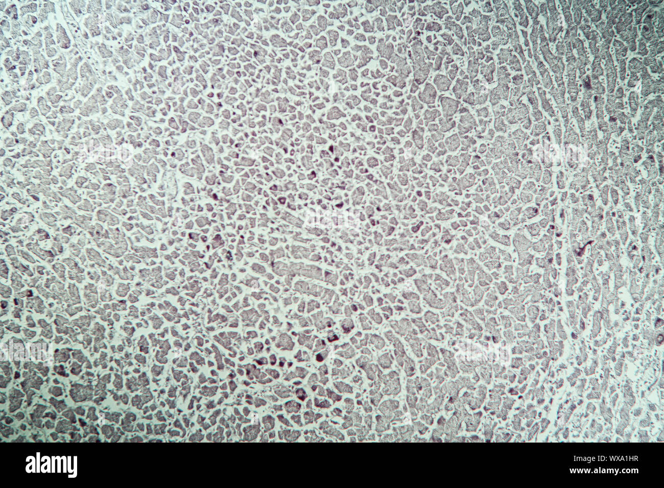 Liver with hepatitis marker diseased tissue under the microscope 100x ...