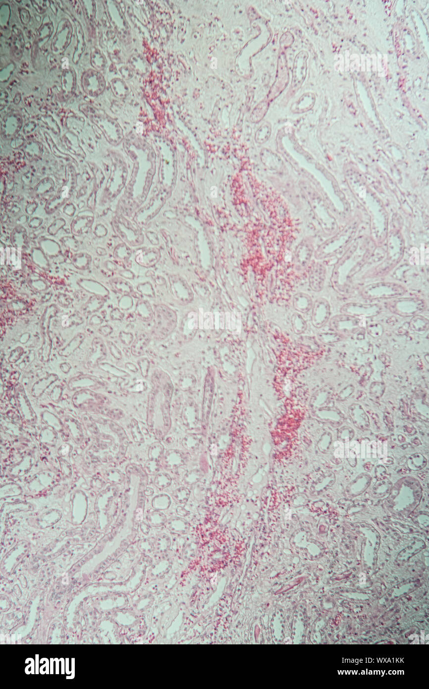 Nephritis hi-res stock photography and images - Alamy
