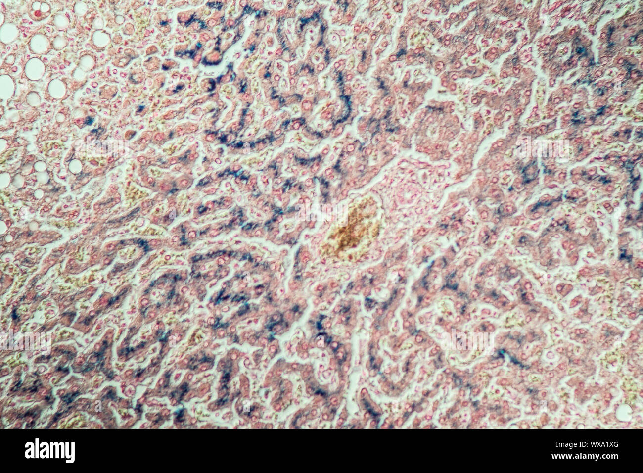 Hamosiderosis hi-res stock photography and images - Alamy