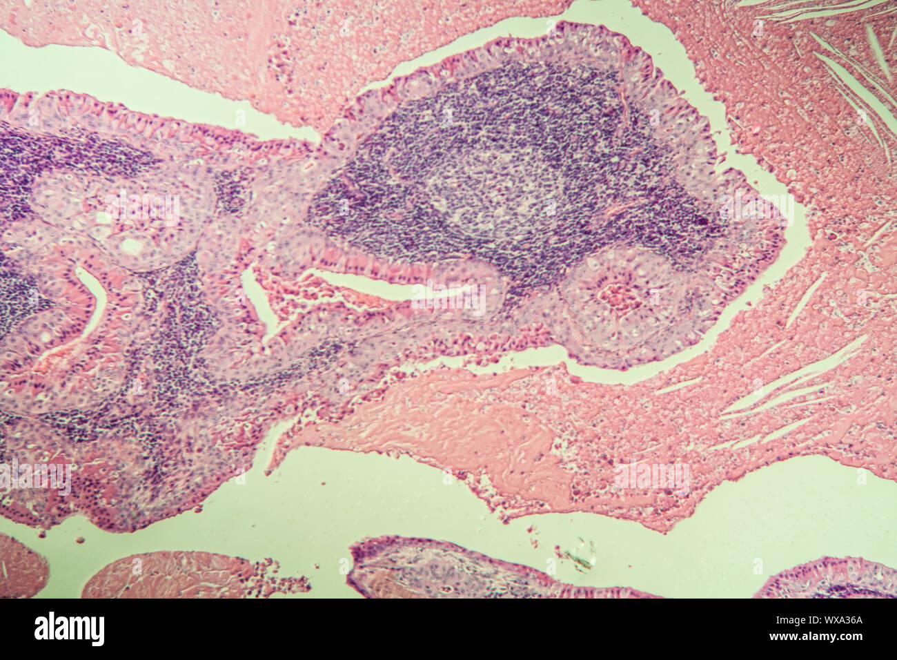 Cyst adenolymphoma diseased tissue under the microscope 100x Stock ...